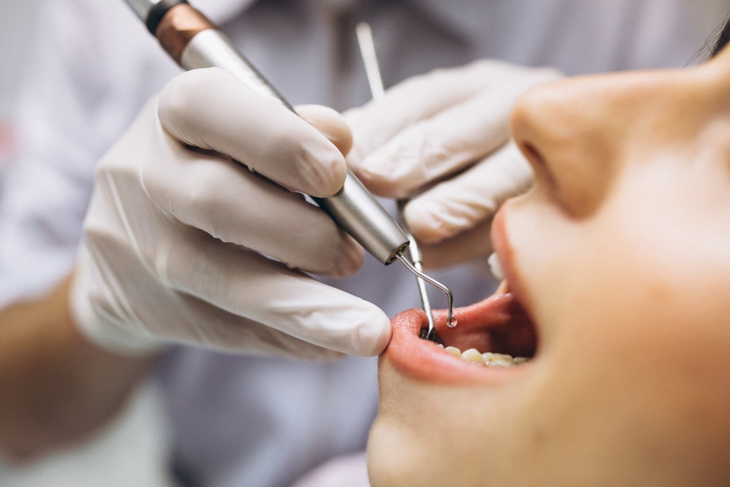 Root Canal Causes You Need to Know - Dentistry at Bonney Lake